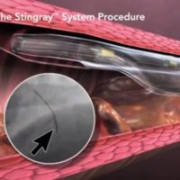 CrossBoss™ Coronary Catheter – Meditek Systems