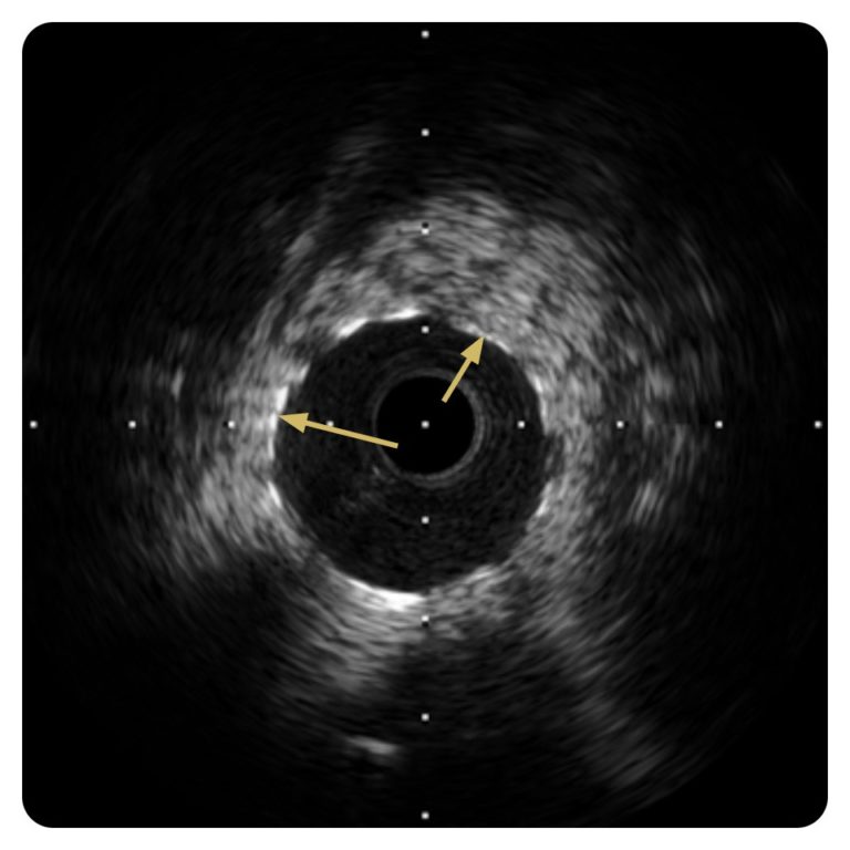 OptiCross™ Coronary Imaging Catheter – Meditek Systems