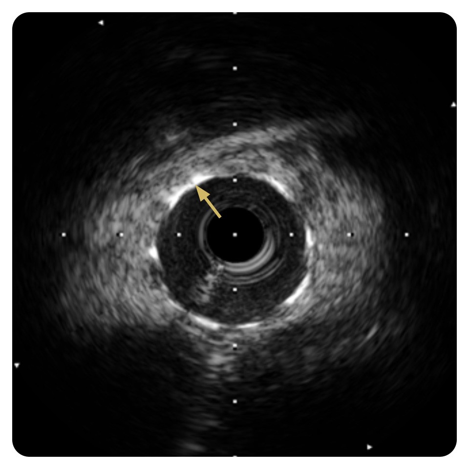 OptiCross™ Coronary Imaging Catheter – Meditek Systems