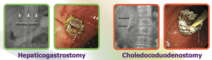 Hybrid Stent – Meditek Systems
